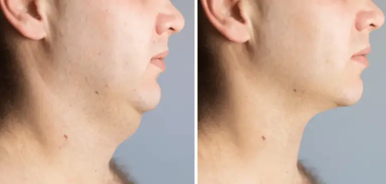 Adiós papada y cachetes: Descubre cómo deshacerte de ellos fácilmente